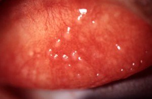 Enlarged Papillae - Pictures, Symptoms, Causes, Treatment