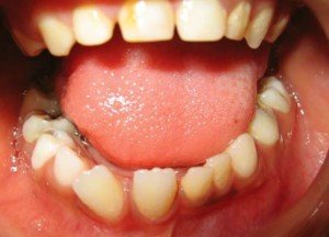 Enlarged Papillae - Pictures, Symptoms, Causes, Treatment