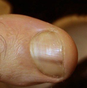 Melanonychia - Causes, Pictures, Symptoms, Treatment