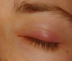 Eyelid Infection - Pictures, Causes, Treatment, Remedies