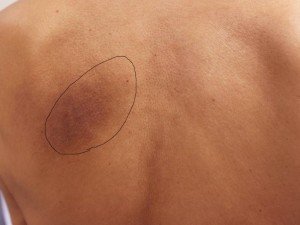 Notalgia Paresthetica - Symptoms, Treatment, Exercises, Causes
